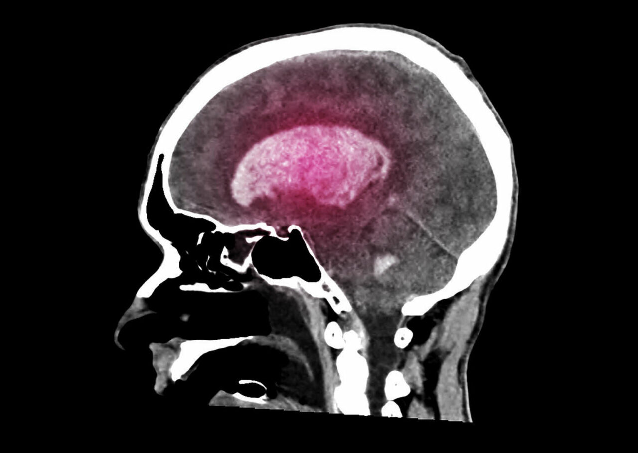 Craniotomy for Hematoma - Hart Garner, MD - Minnesota Spinal Neurosurgeon