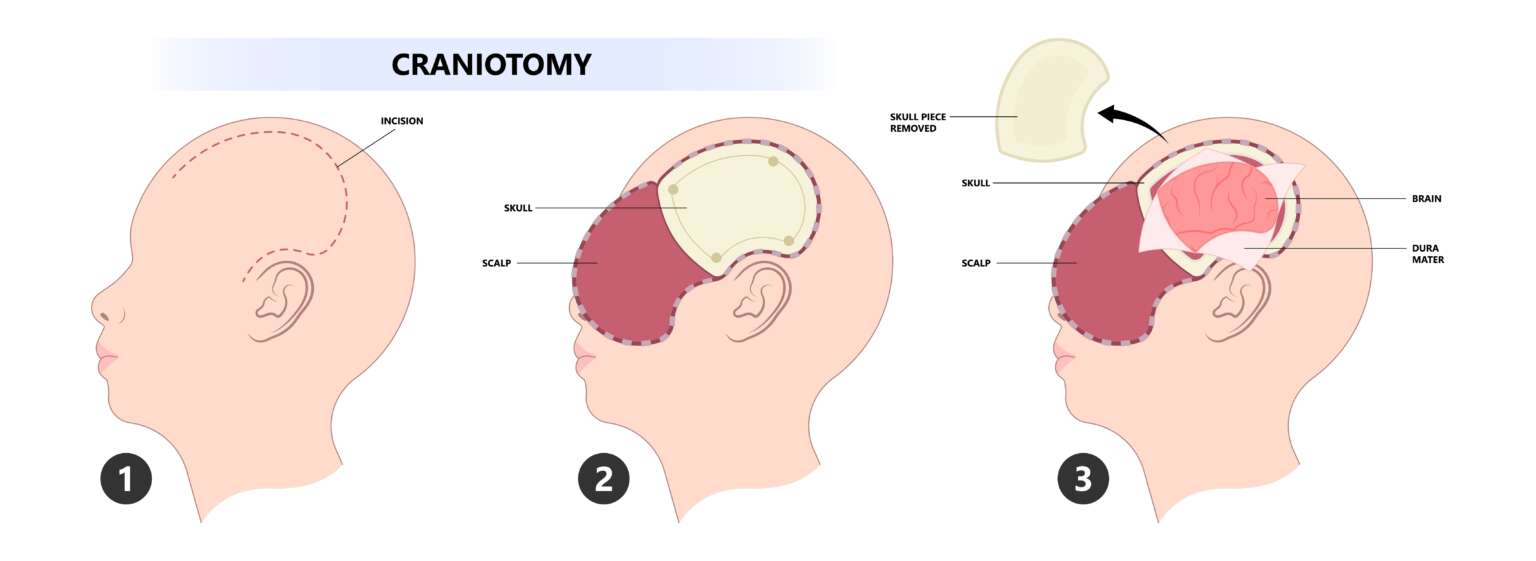 Craniotomy For Tumor Hart Garner MD Minnesota Spinal Neurosurgeon Craniotomy For Tumor Hart Garner MD Minnesota Spinal Neurosurgeon